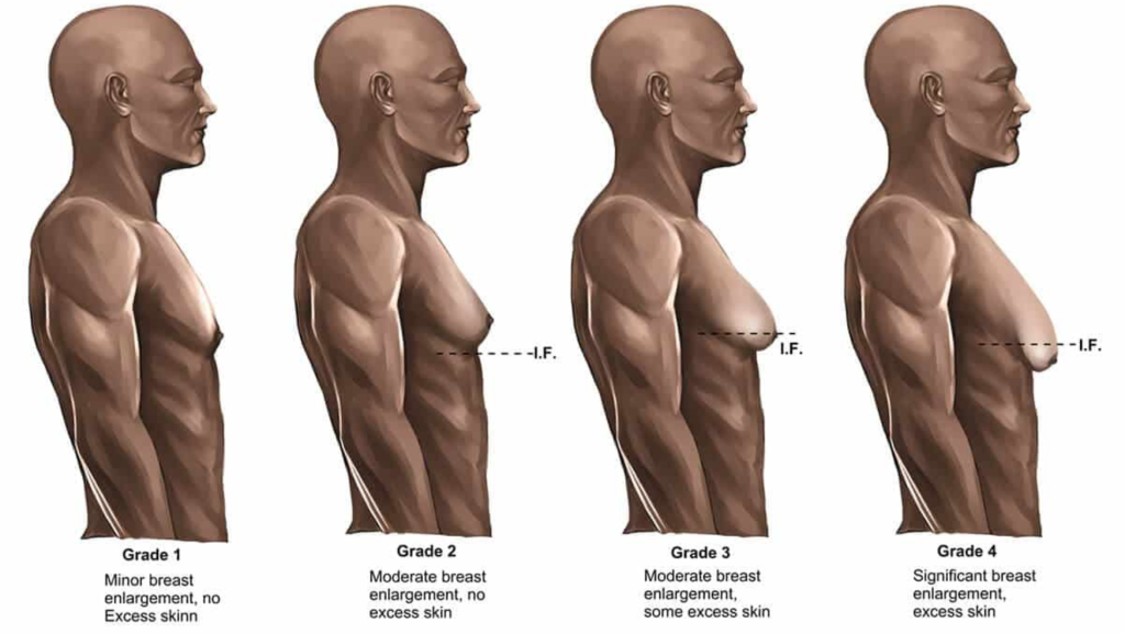 Gynecomastia: The Role of Obesity and Treatment - NBOFITNESS