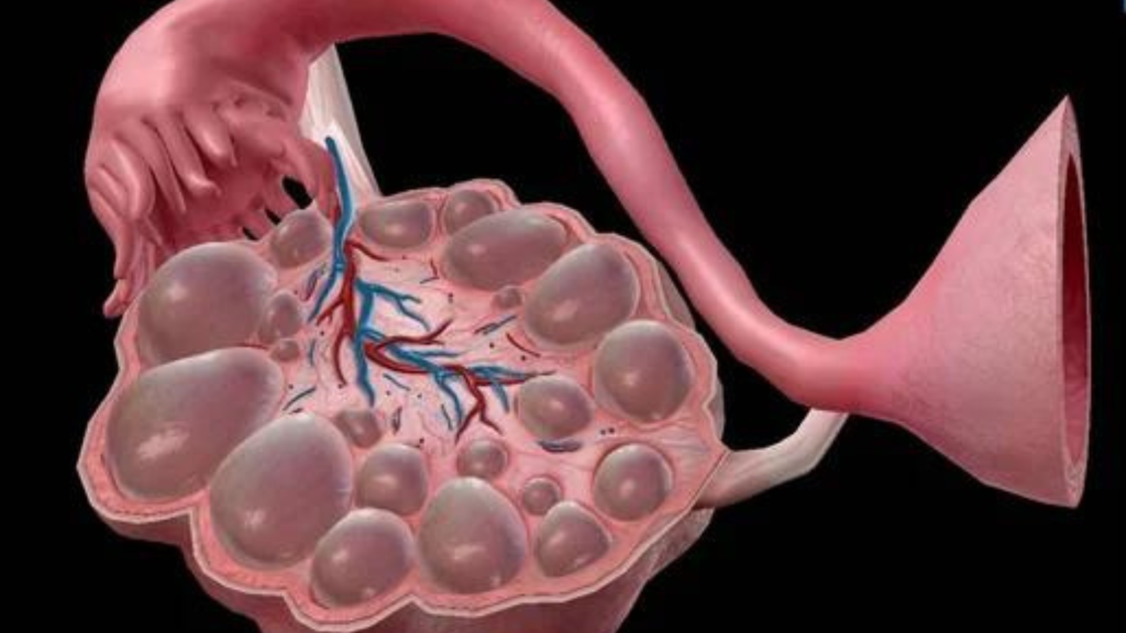 Polycystic Ovary Syndrome (PCOS) and Obesity - NBOFITNESS